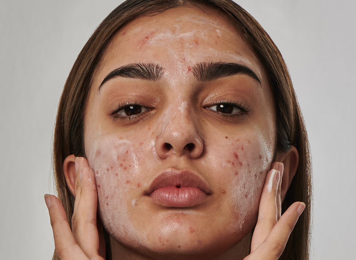 Benzoyl Peroxide : What you need to know