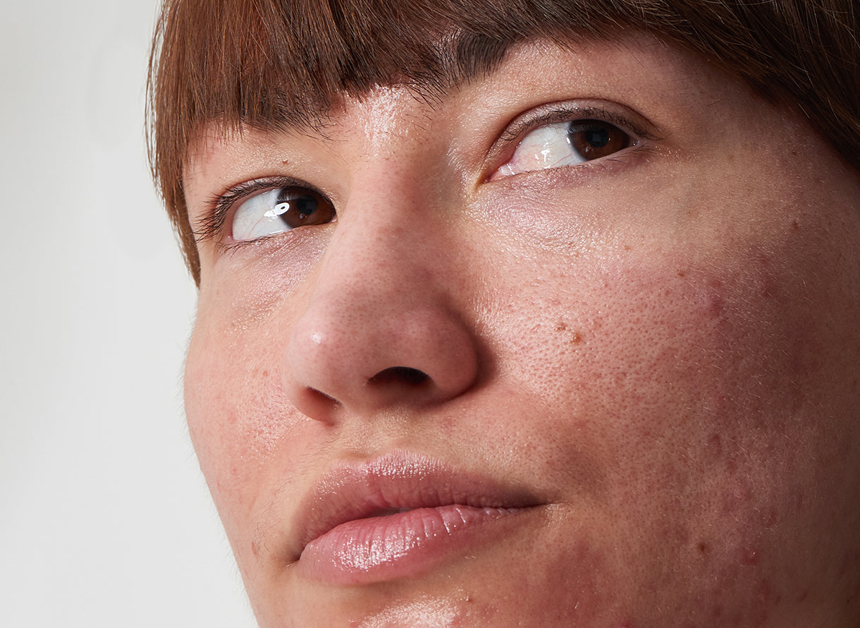 How to get rid of blemishes fast | The INKEY List