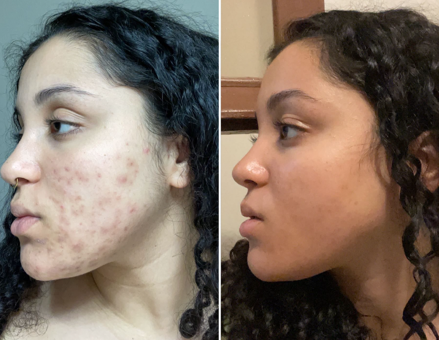 Blemishes & Scarring Results With INKEY