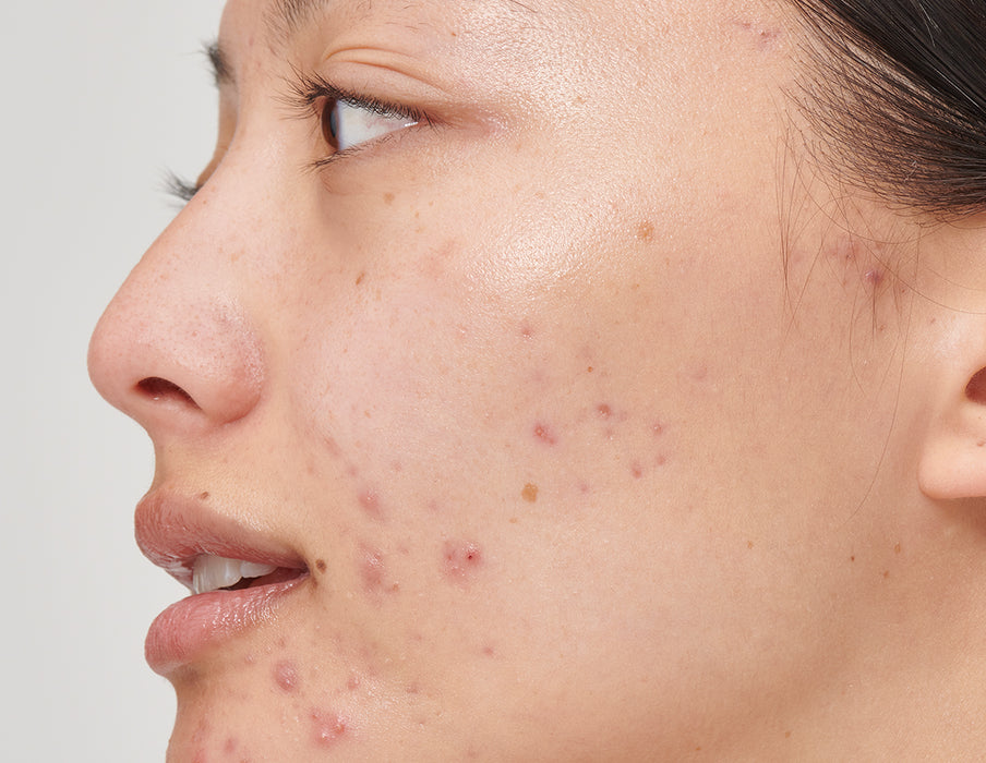 What Type Of Acne Do I Have? | The INKEY List