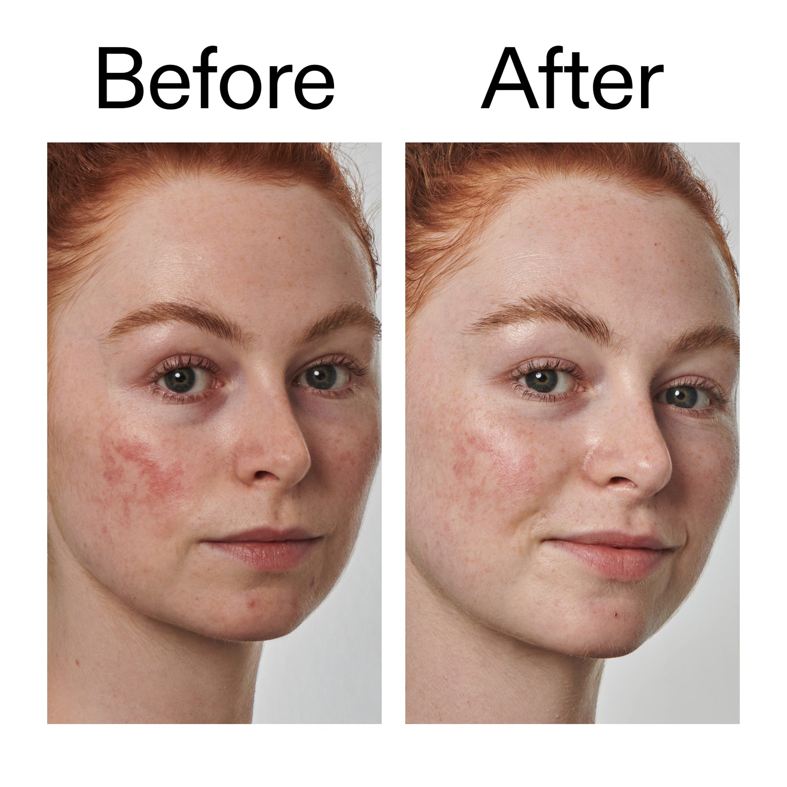 10% Azelaic Acid Serum - Anti Redness Formula | The INKEY List USA