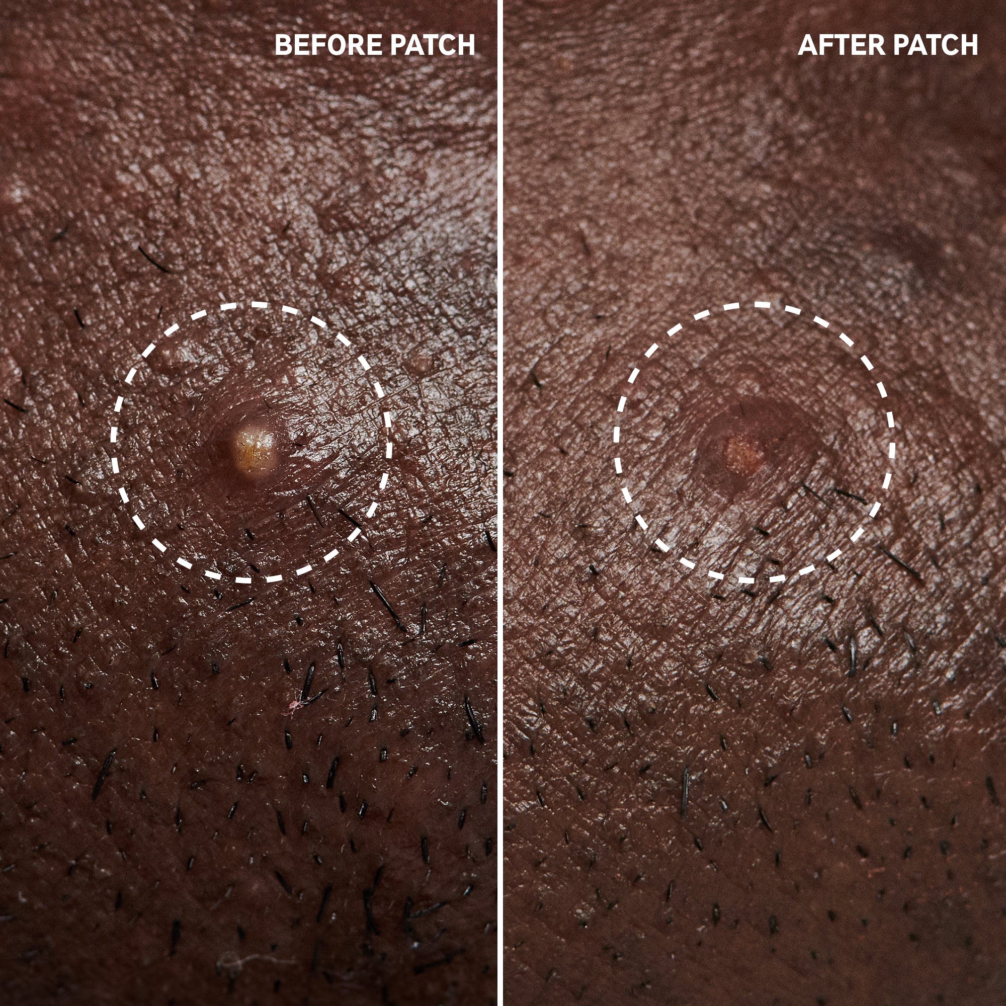 Hydrocolloid Acne Pimple Patch | The INKEY List USA