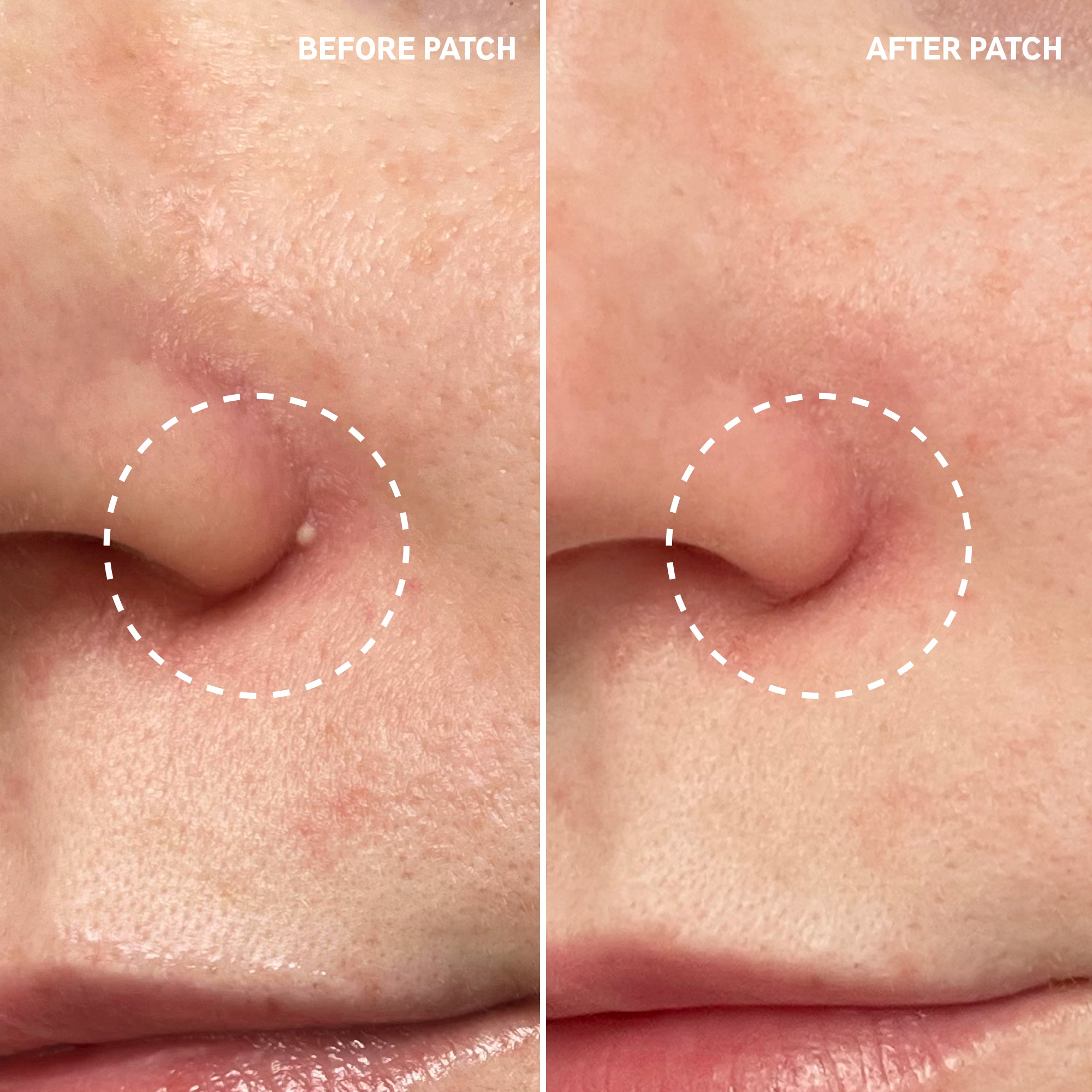 Hydrocolloid Acne Pimple Patch | The INKEY List USA